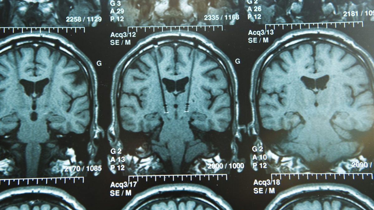 ONLY A SMALL FRACTION OF L-DOPA EVER REACHES THE BRAIN · Parkinson's ...